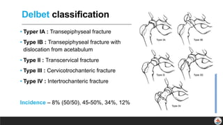 Proximal Femoral Fracture in Ped.pdf