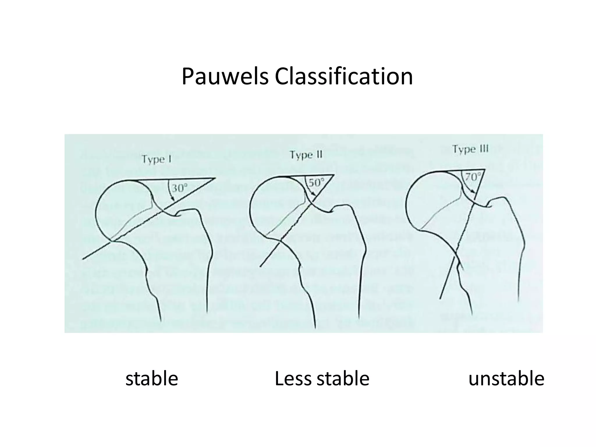 proximalfemoralfractures-190716152524.pptx