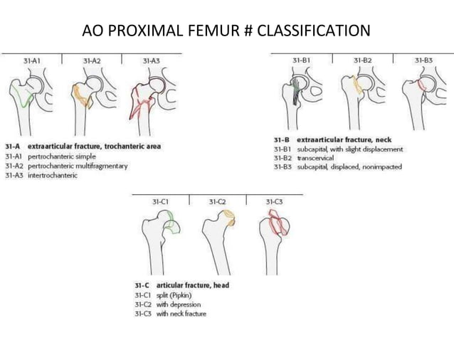proximalfemoralfractures-190716152524.pptx