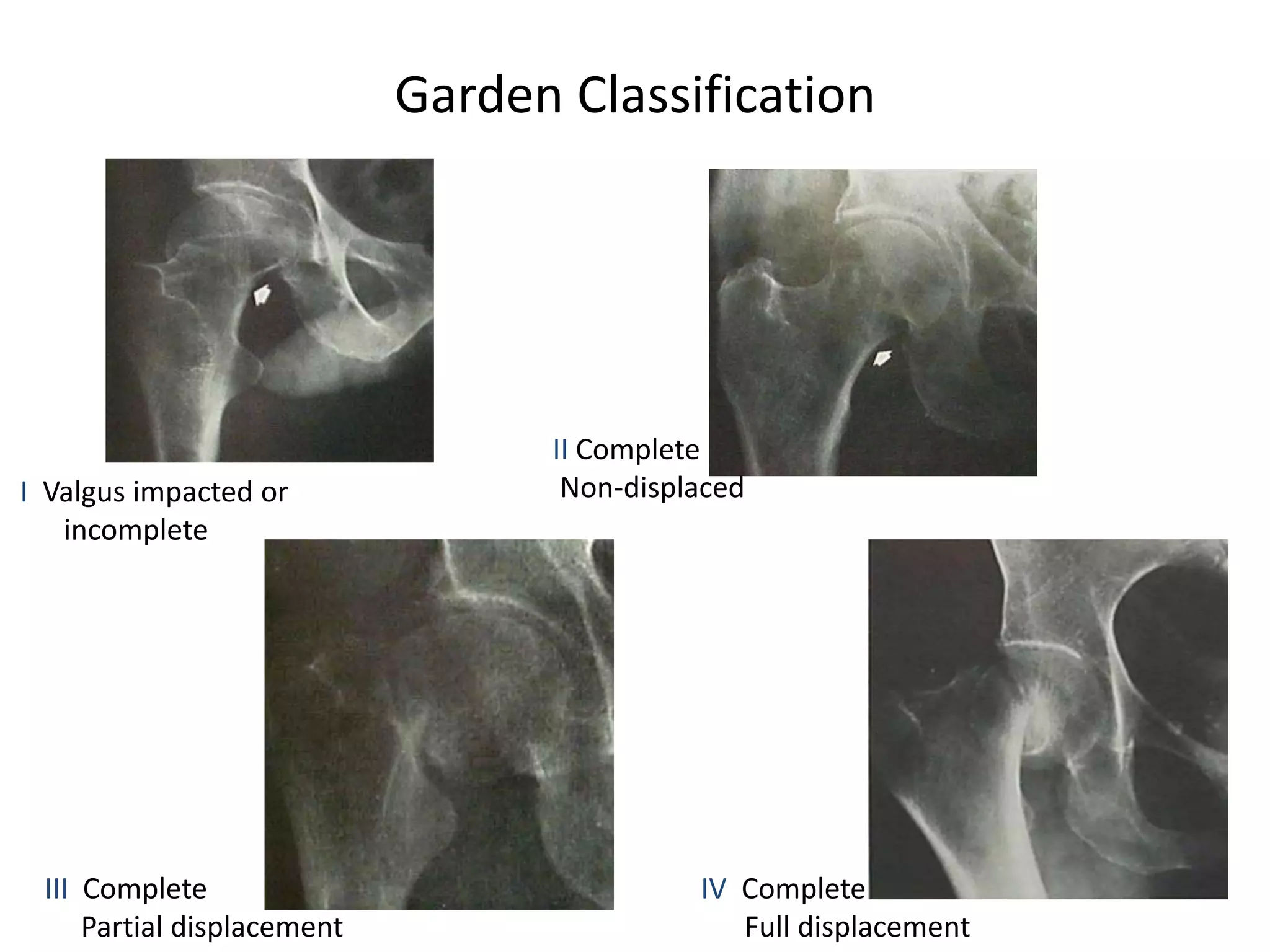 Proximal femoral fractures | PPTX