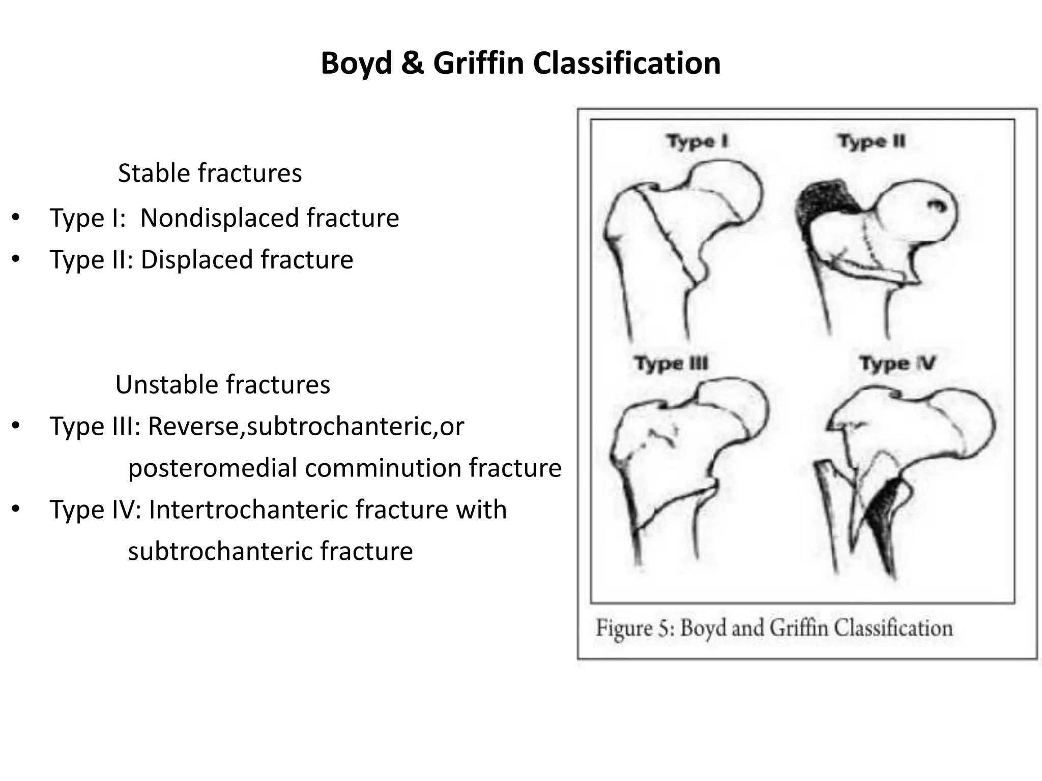 Proximal femoral fractures | PPTX