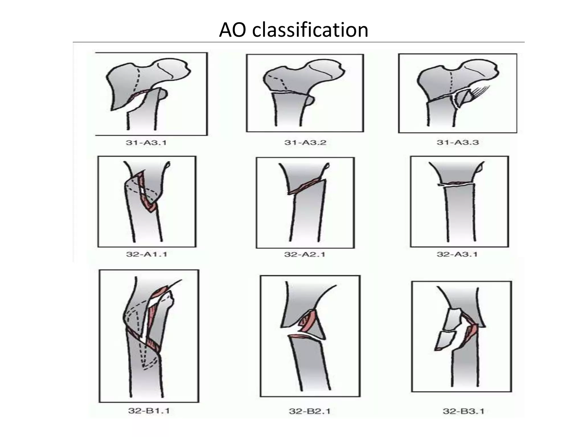 Proximal femoral fractures | PPTX