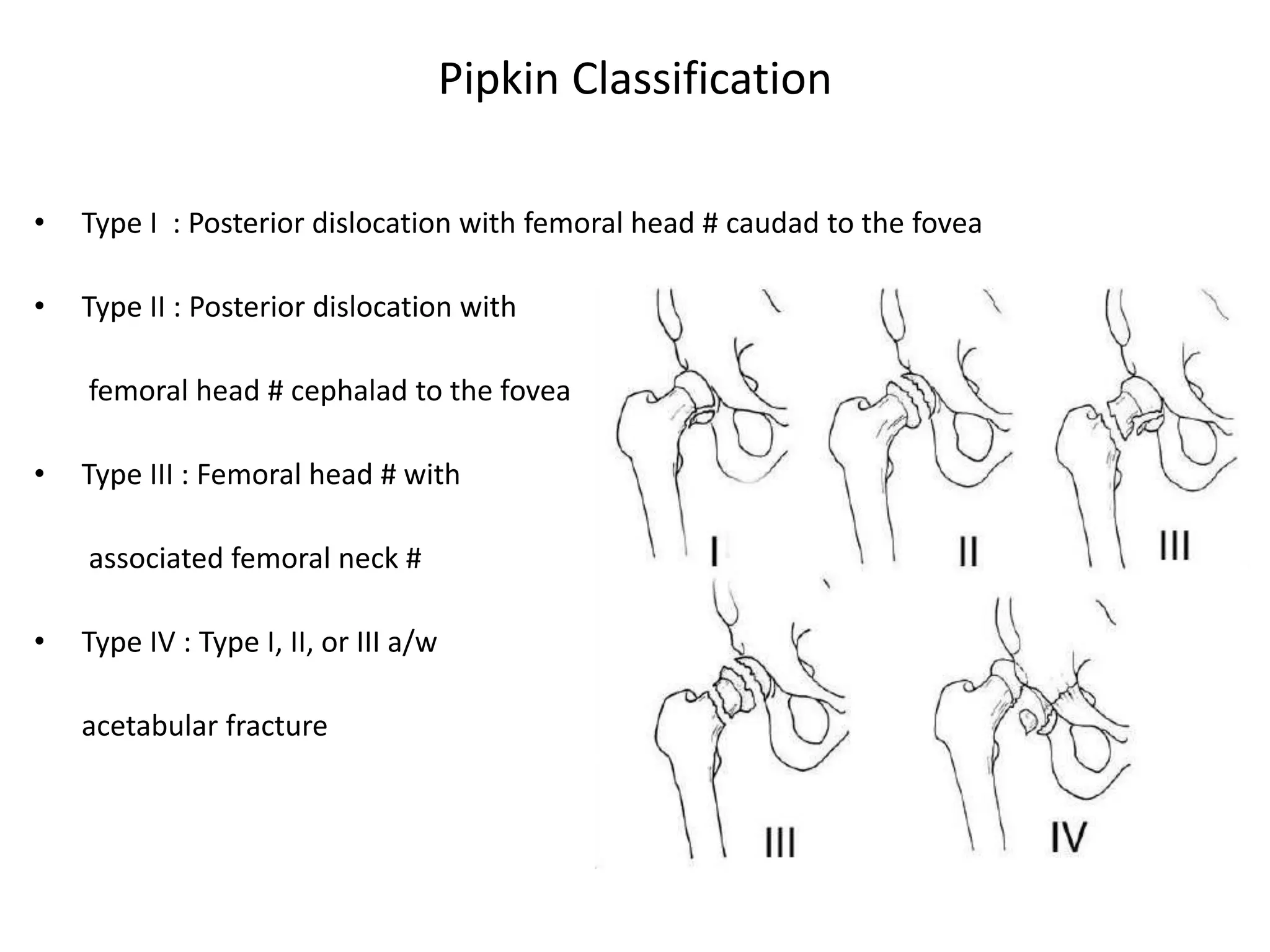 Proximal femoral fractures | PPTX