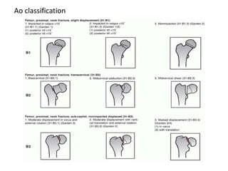 Proximal femoral fractures | PPTX