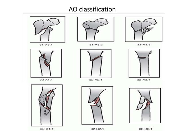 Ao/Ota Classification Of Proximal Femoral Fractures – YWOJ