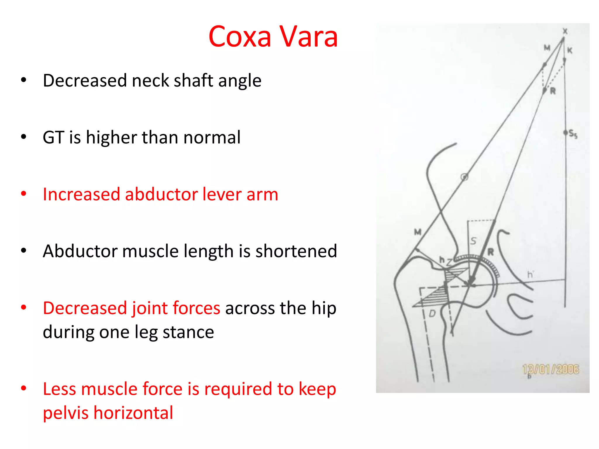 Proximal femoral osteotomies.pptx