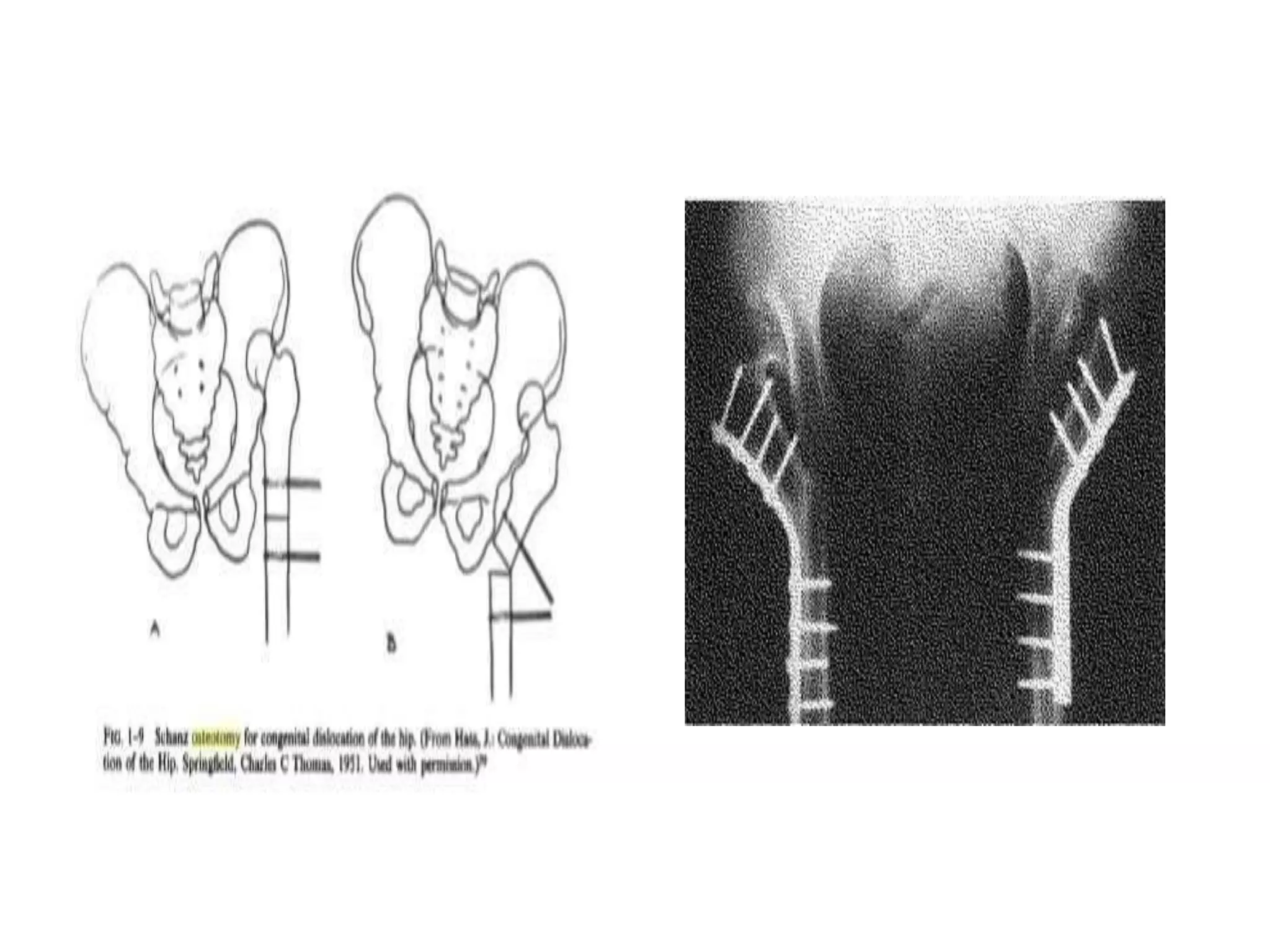Proximal femoral osteotomies.pptx