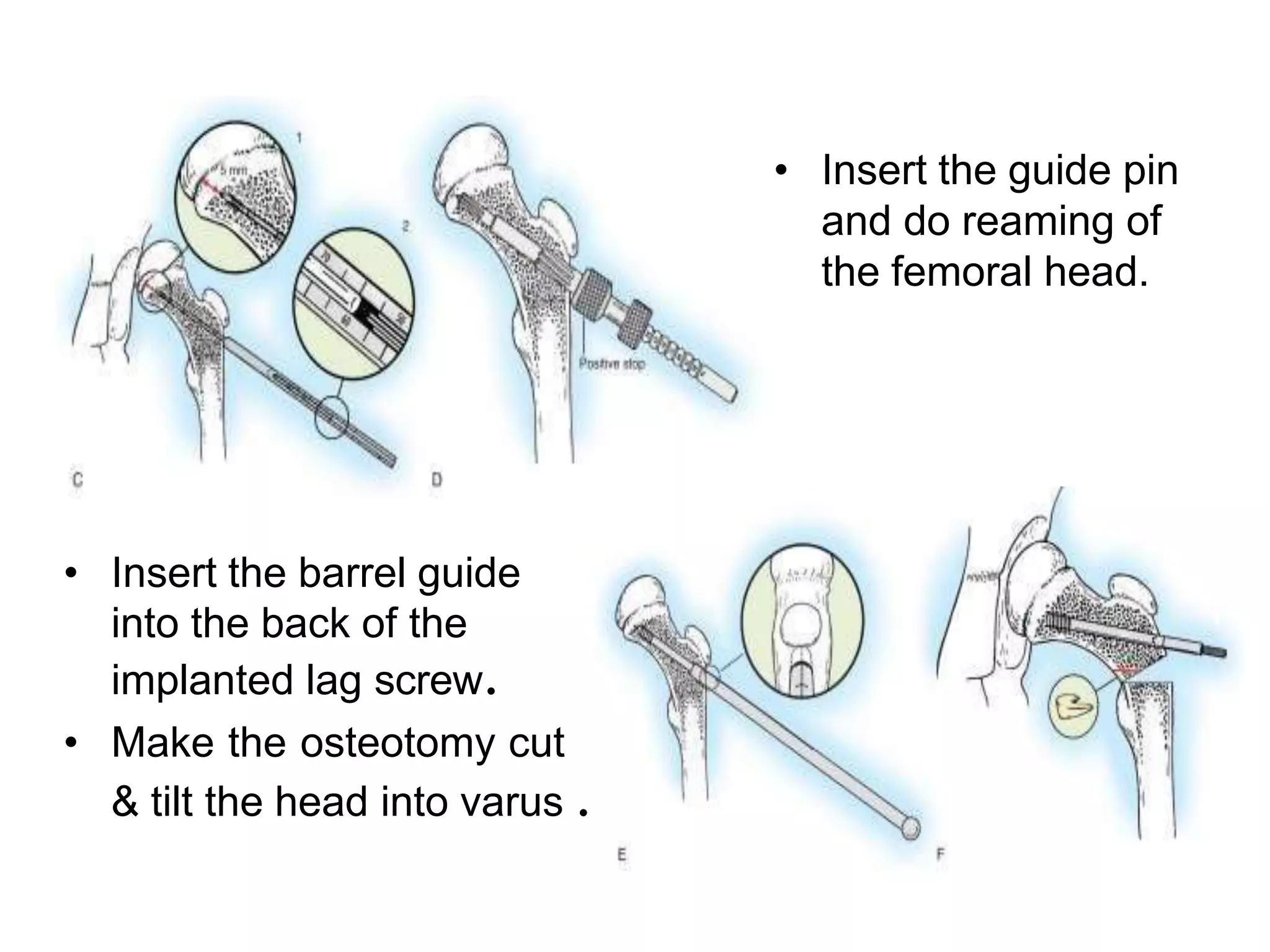 Proximal femoral osteotomies.pptx