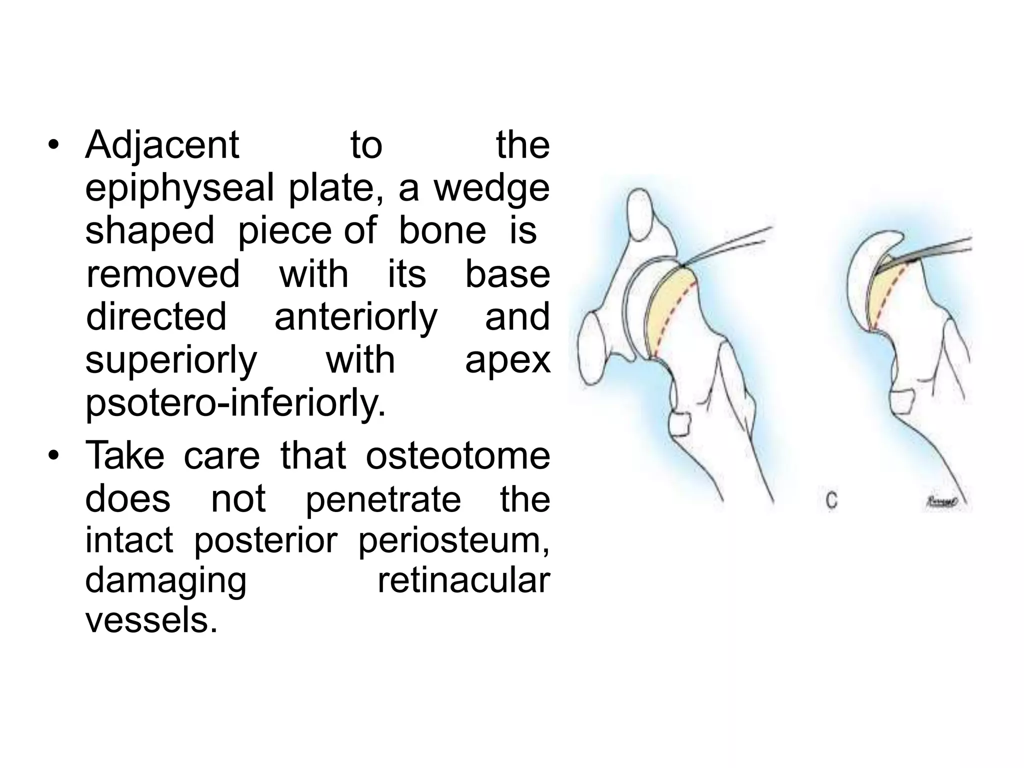 Proximal femoral osteotomies.pptx
