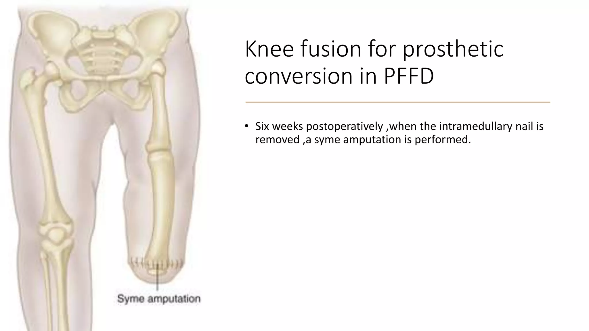 Proximal femur focal def | PPTX
