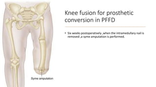 Proximal femur focal def | PPT