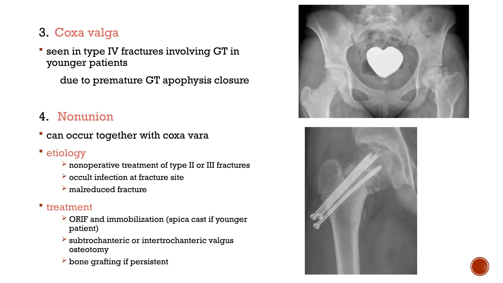 Proximal femur fracture - pediatrics.pptx