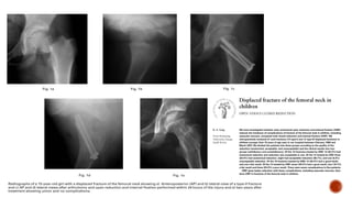 Proximal femur fracture - pediatrics.pptx