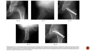 Proximal femur fracture - pediatrics.pptx