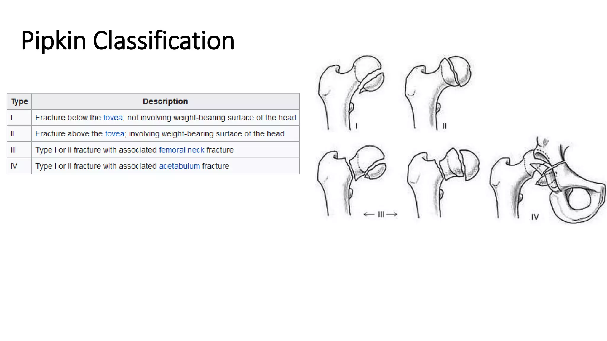 Proximal femur fractures | PPTX
