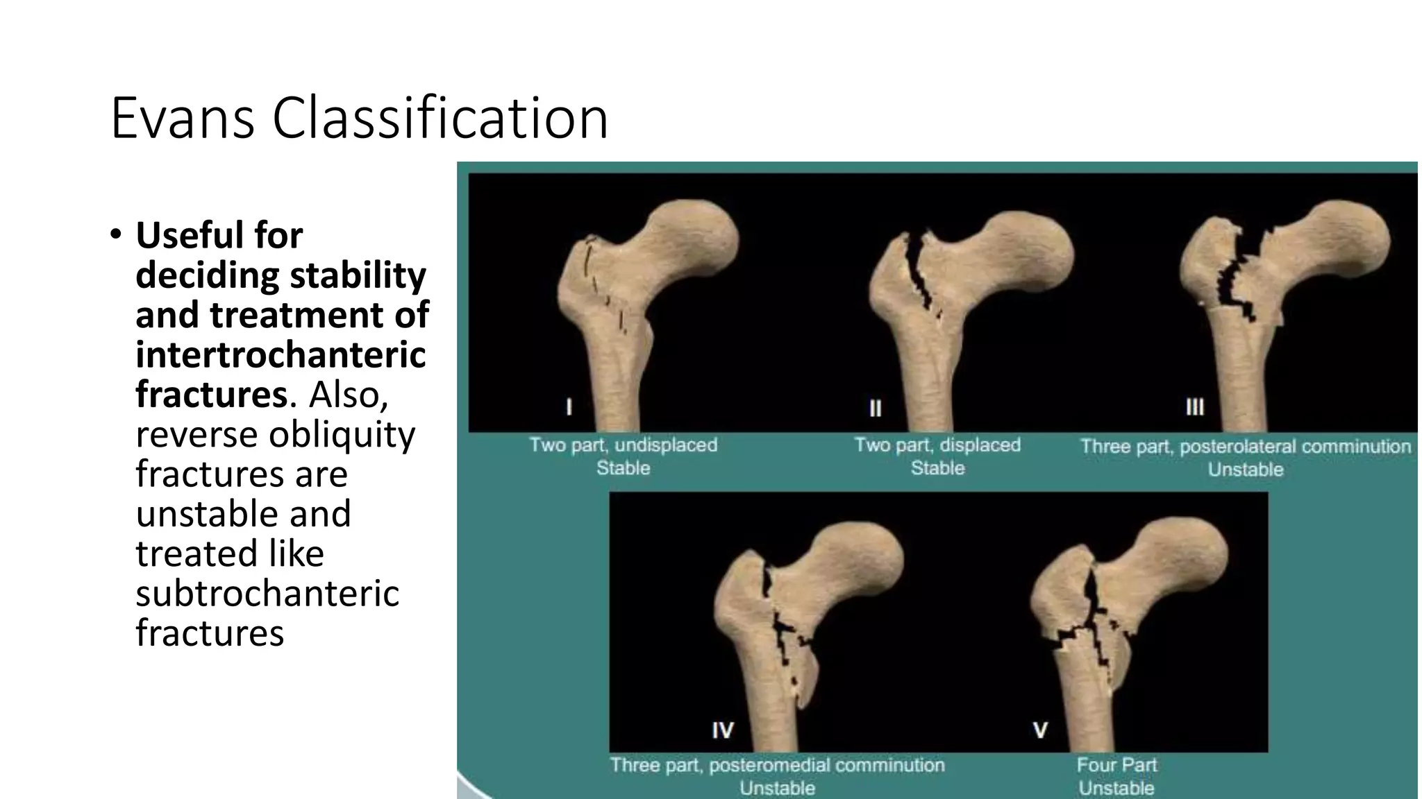 Proximal femur fractures | PPTX