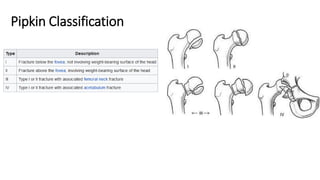 Proximal femur fractures | PPTX