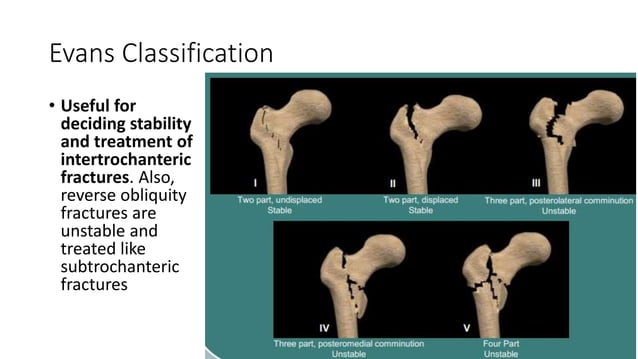Proximal femur fractures | PPTX