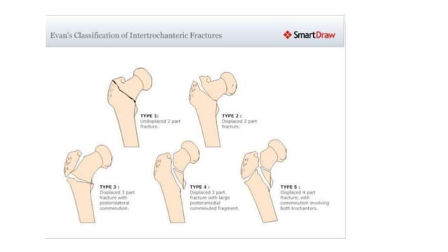 Proximal femur fractures | PPTX