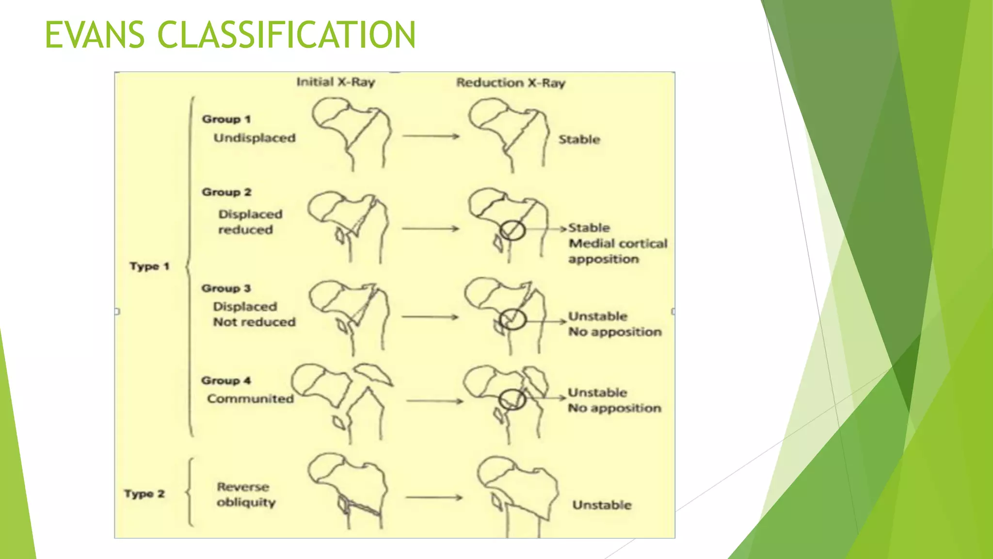 Proximal femur fractures | PPTX