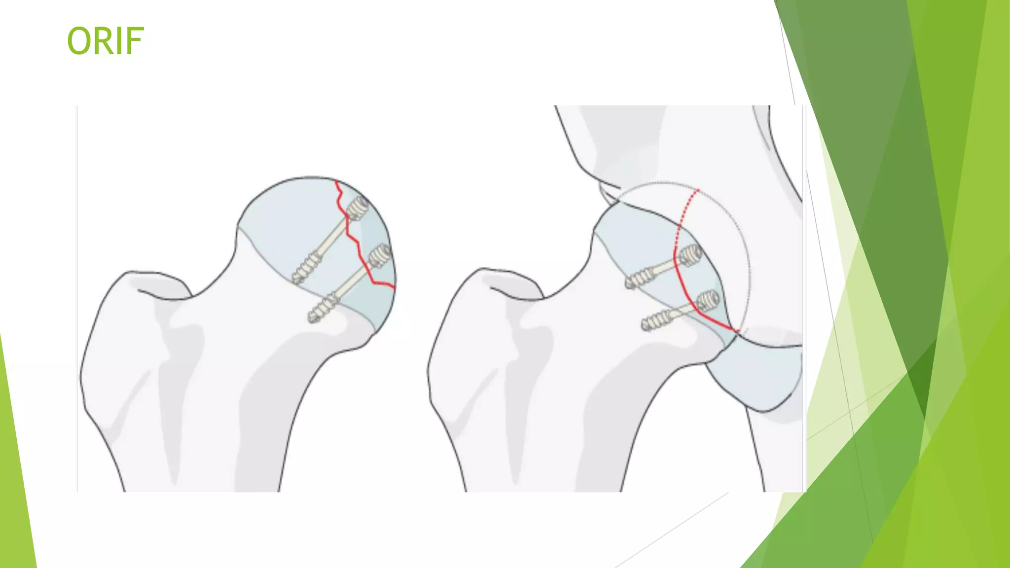 Proximal femur fractures | PPTX