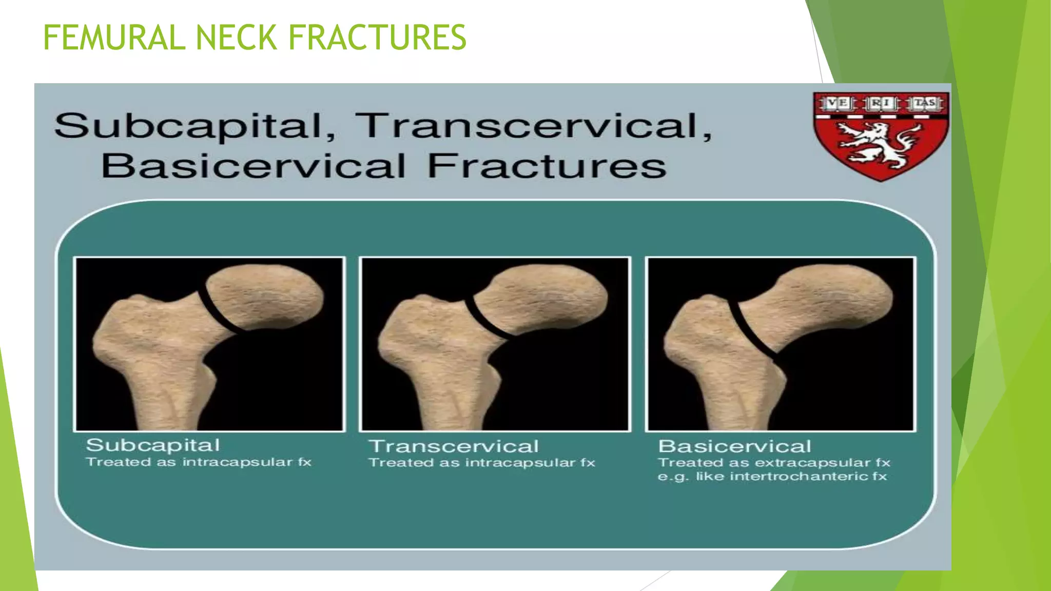 Proximal femur fractures | PPTX