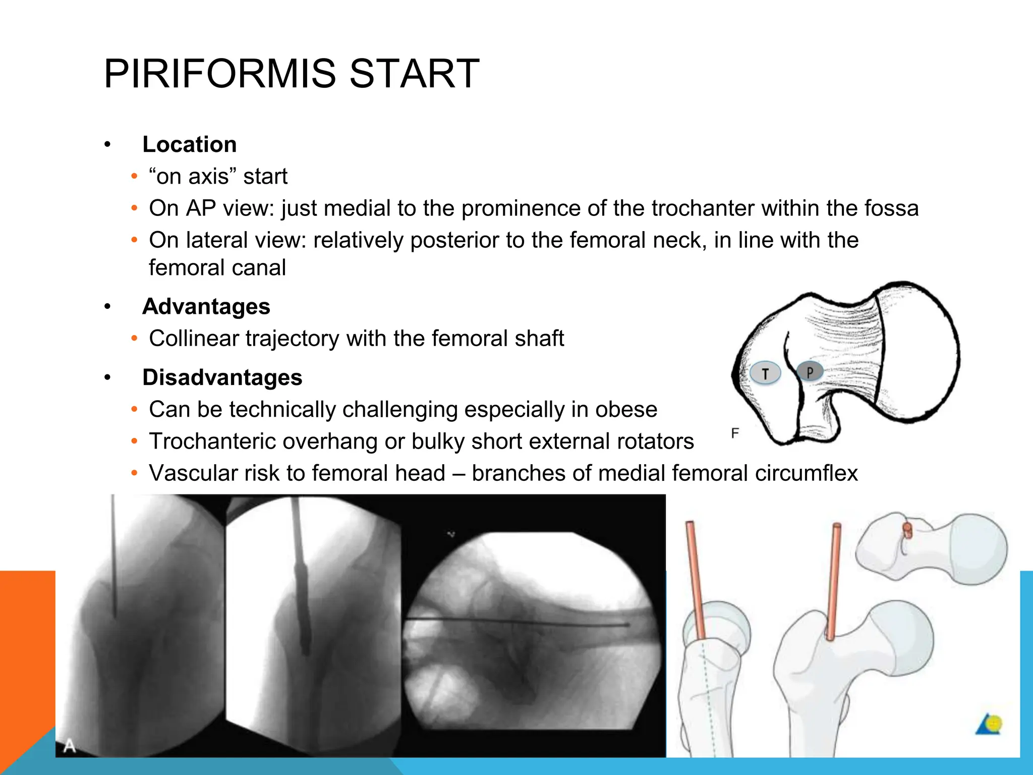 Proximal Femur Nail Start Points.pptx