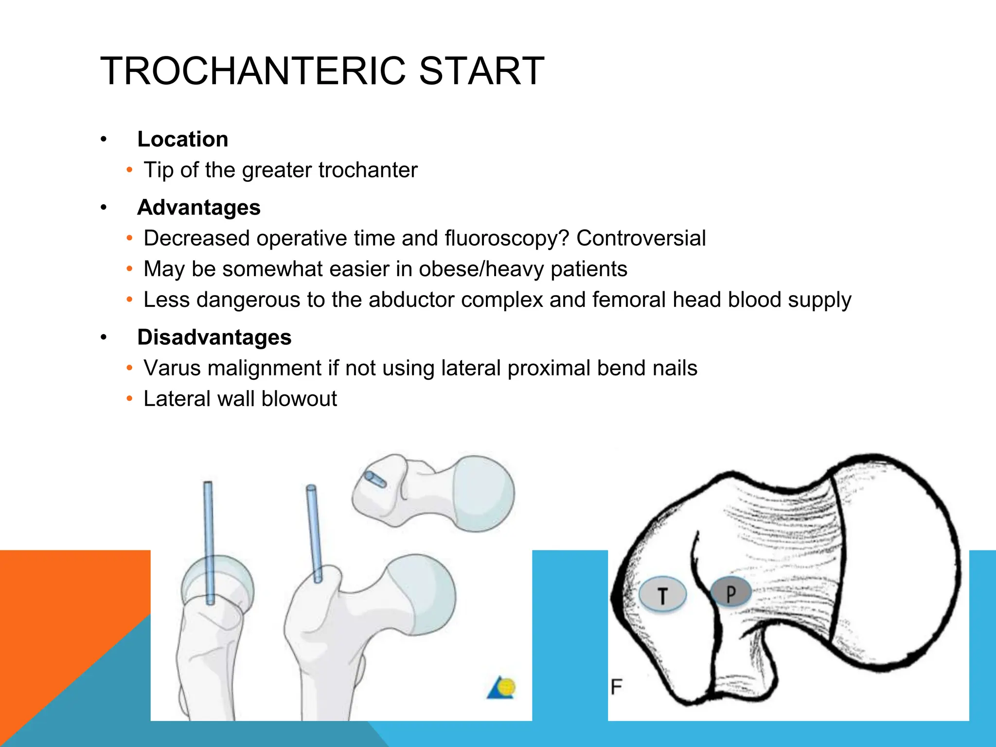 Proximal Femur Nail Start Points.pptx