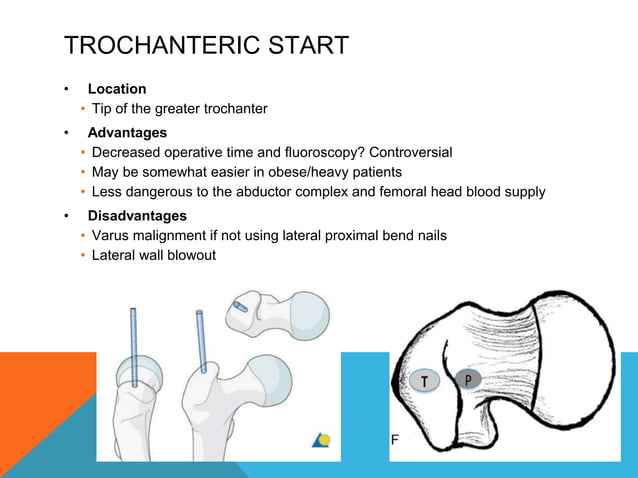 Proximal Femur Nail Start Points.pptx | Death, Injury, or Military ...