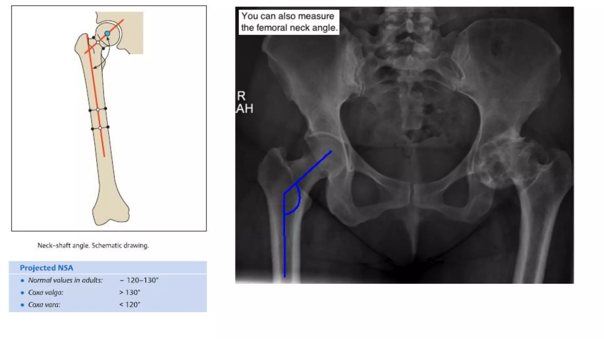 Proximal femur orthopaedic anatomy | PDF