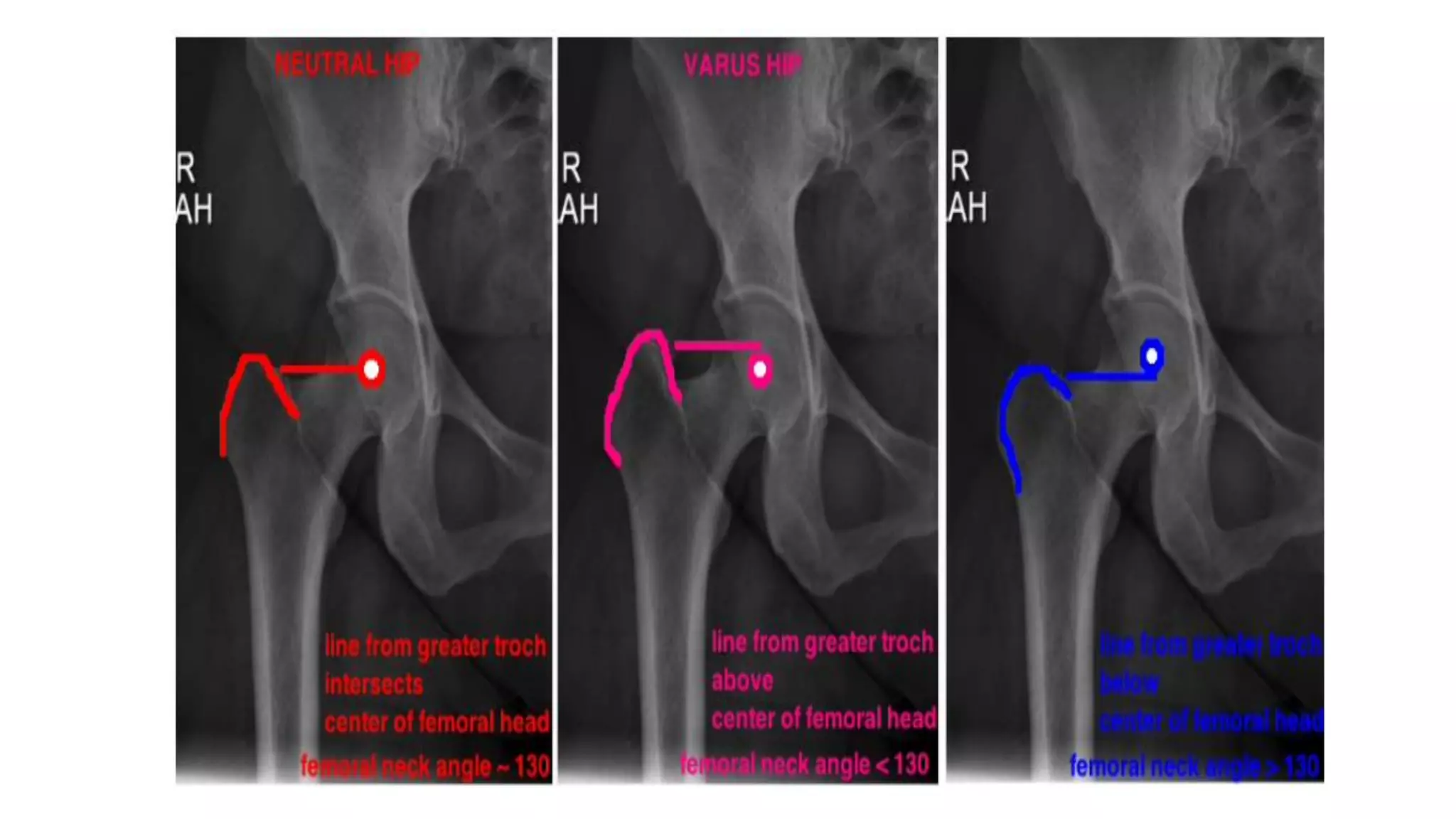 Proximal femur orthopaedic anatomy | PDF