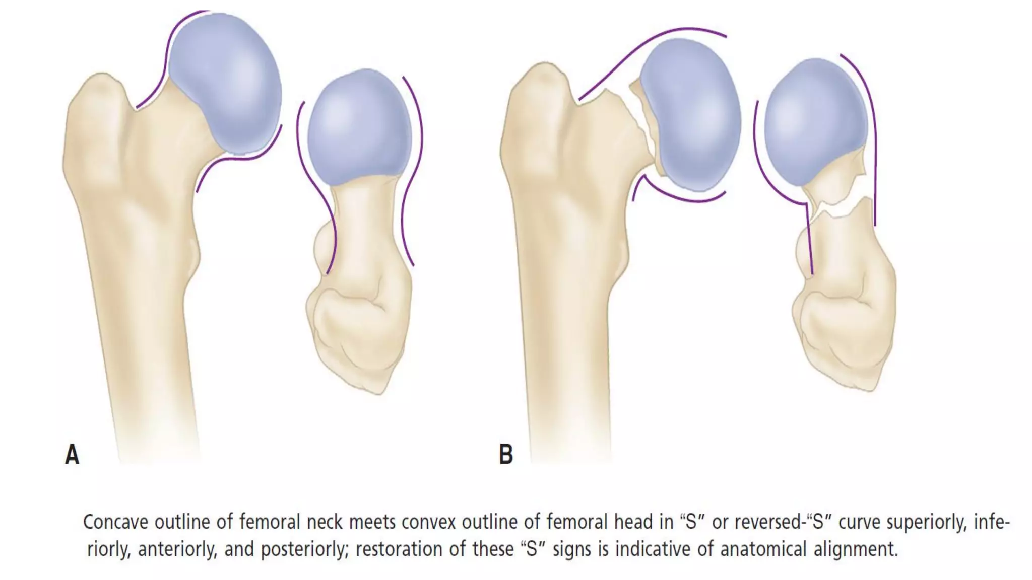 Proximal femur orthopaedic anatomy | PDF