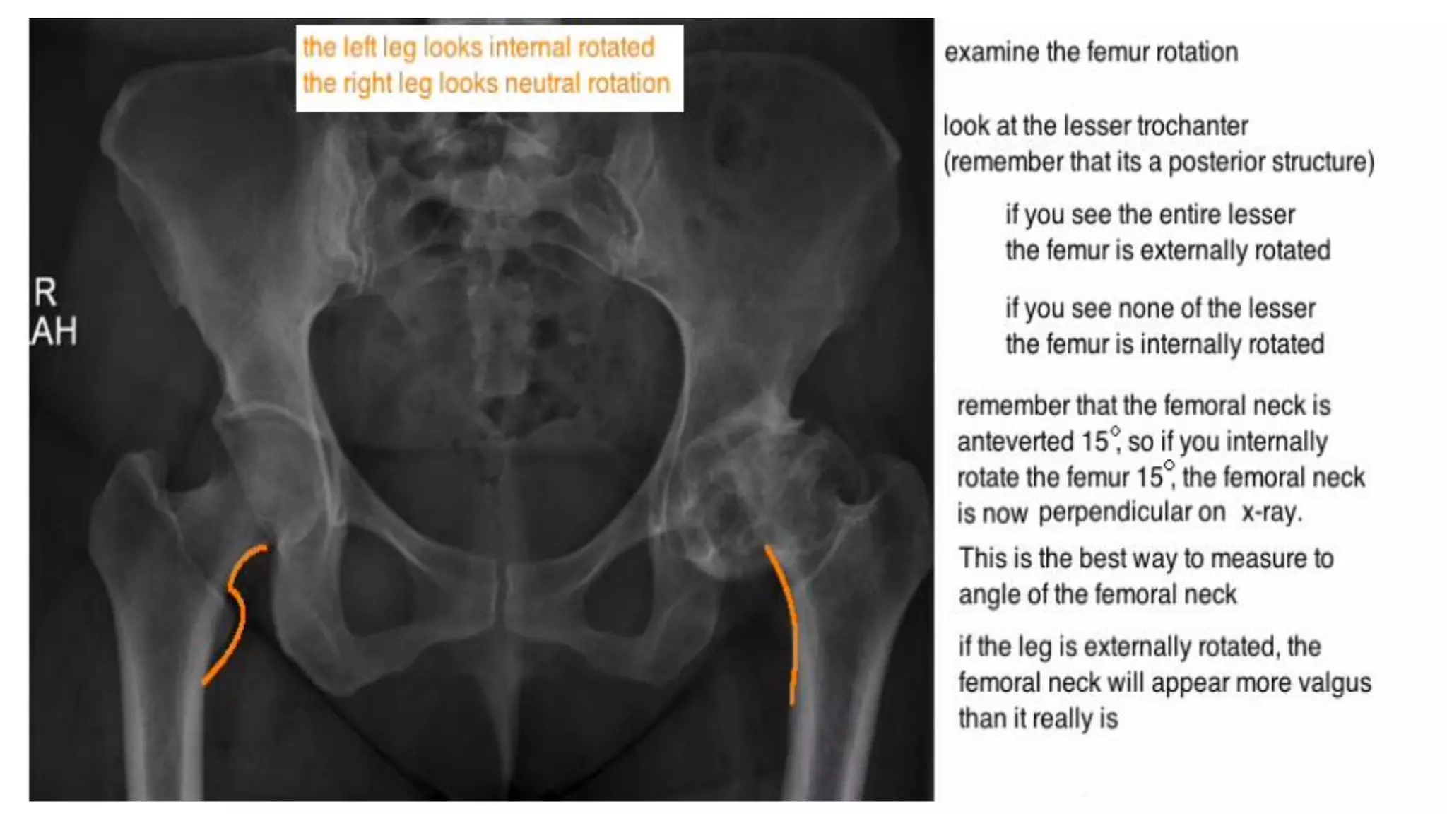 Proximal femur orthopaedic anatomy | PDF