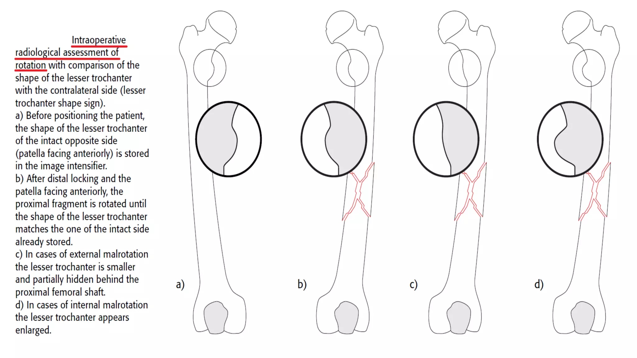 Proximal femur orthopaedic anatomy | PDF