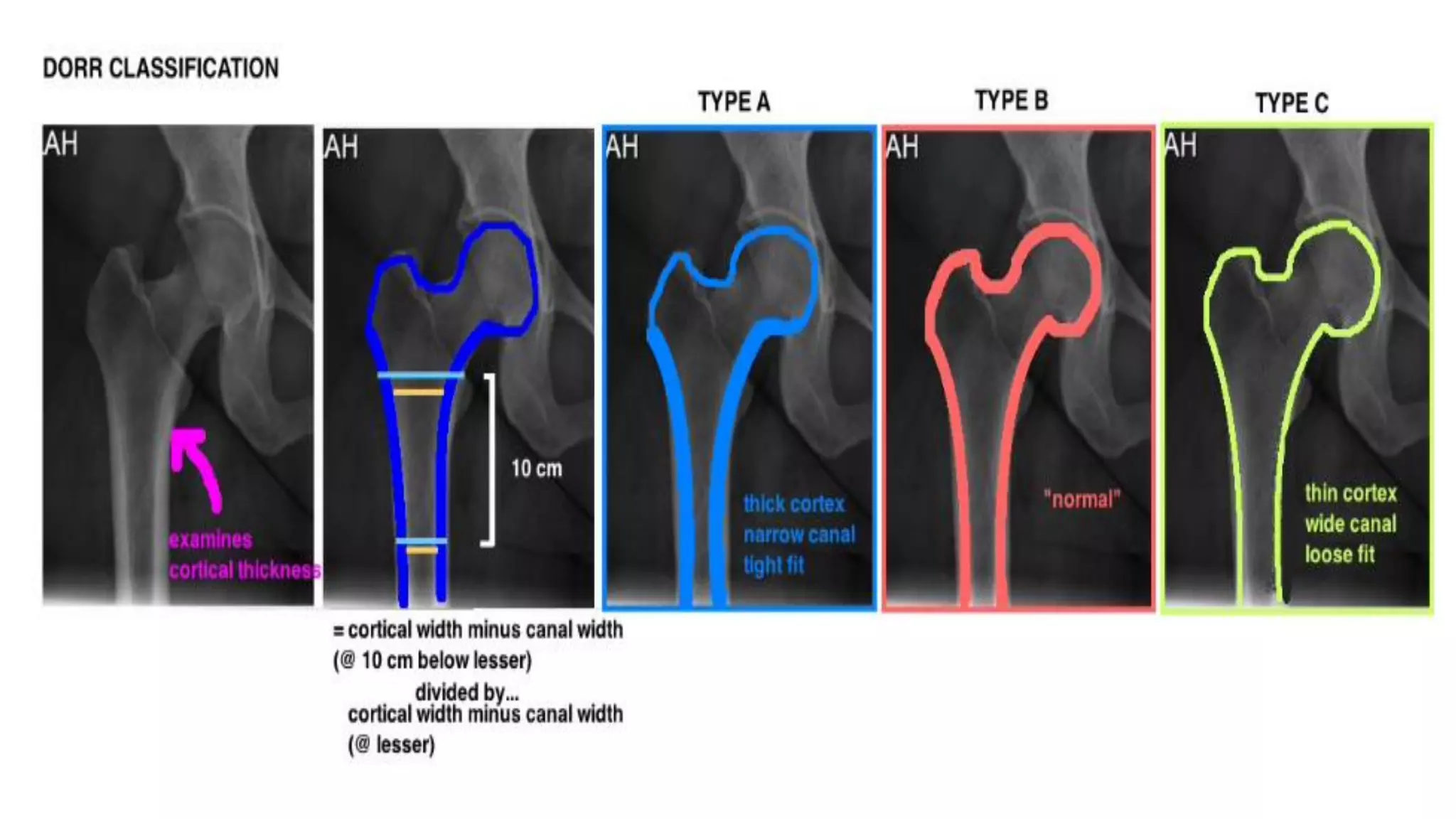 Proximal femur orthopaedic anatomy | PDF