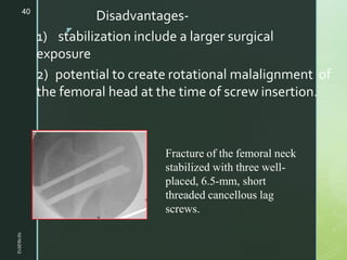 PROXIMAL FRACTURE OF FEMUR.pptx