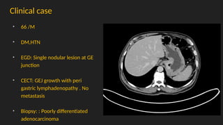Proximal Gastrectomy With Double Tract Reconstruction.pptx