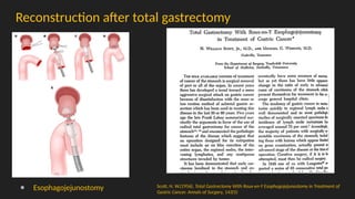 Proximal Gastrectomy With Double Tract Reconstruction.pptx