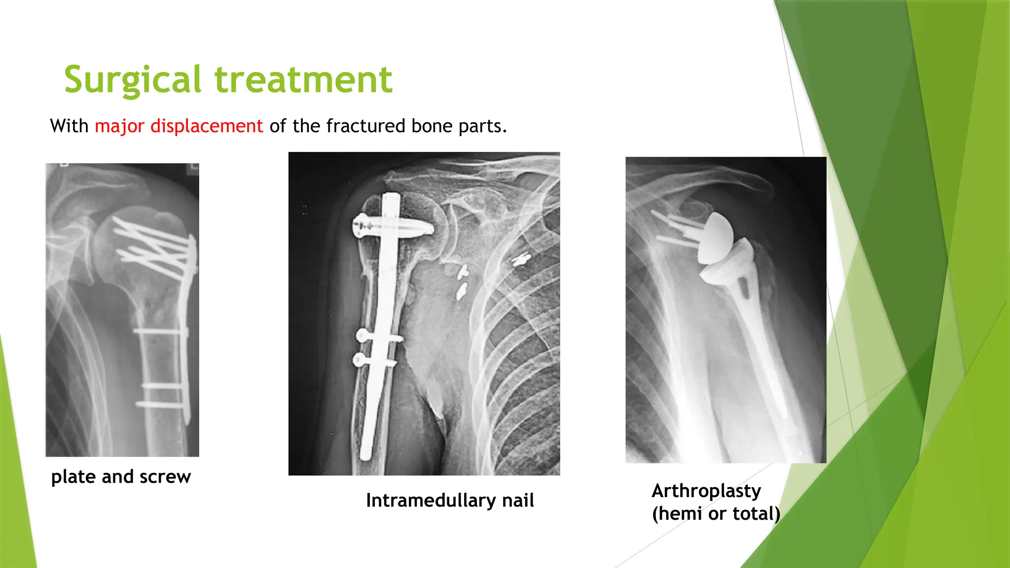 The proximal humeral fractures .pptx