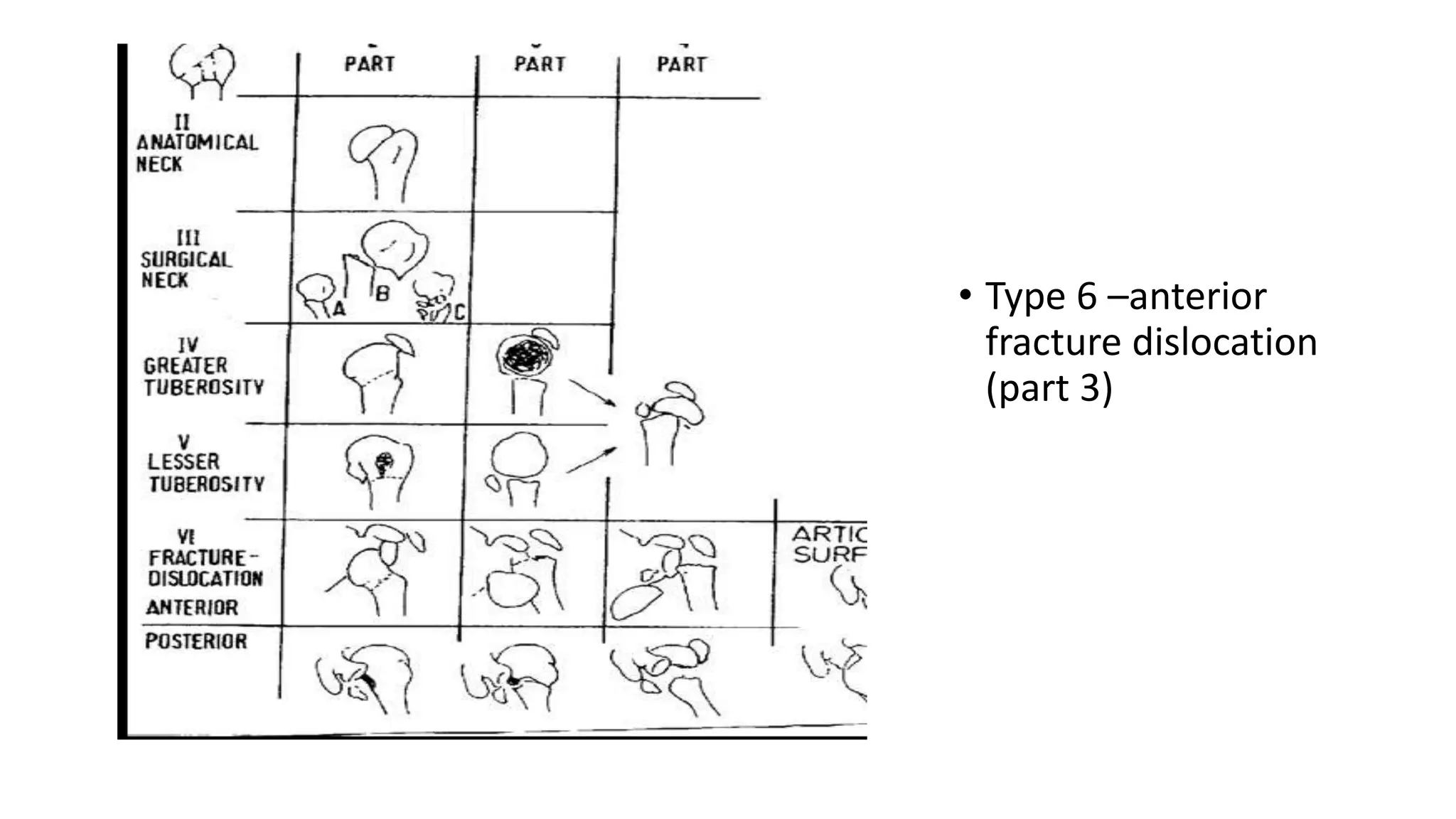 proximal humerus fracture dislocation | PPTX