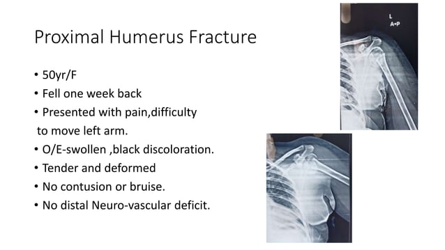 proximal humerus fracture dislocation | PPTX