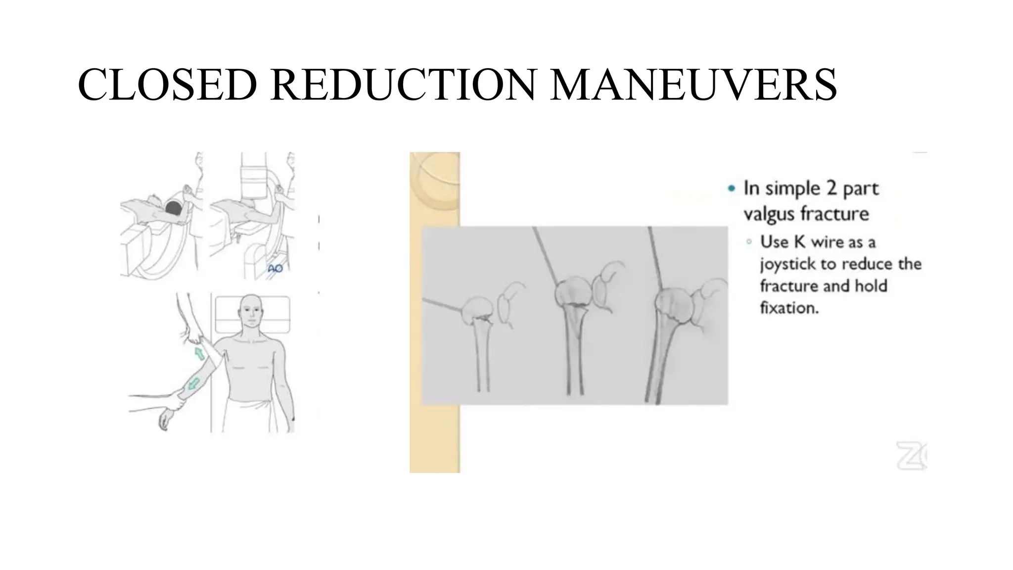 PROXIMAL HUMERUS FRACTURE TREATMENT.pptx