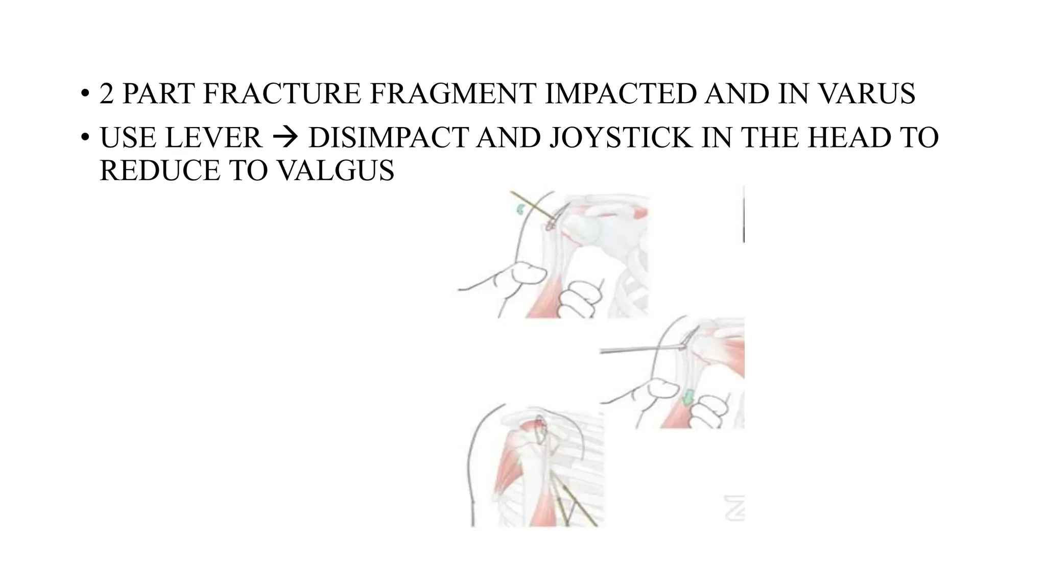 PROXIMAL HUMERUS FRACTURE TREATMENT.pptx