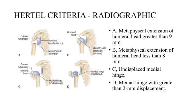 PROXIMAL HUMERUS FRACTURE TREATMENT.pptx | Death, Injury, or Military ...