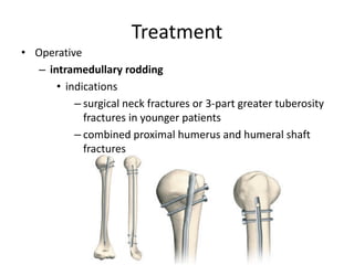Proximal humerus fracture | PPT