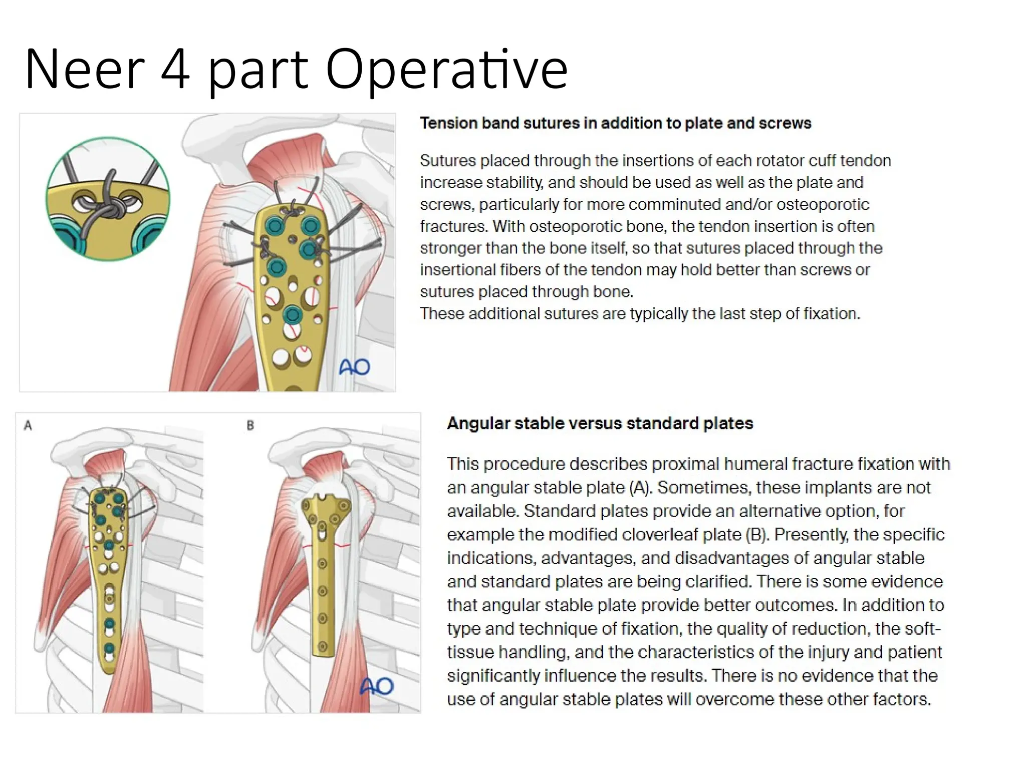 Proximal humerus fracture approach and dangerpptx | PPT
