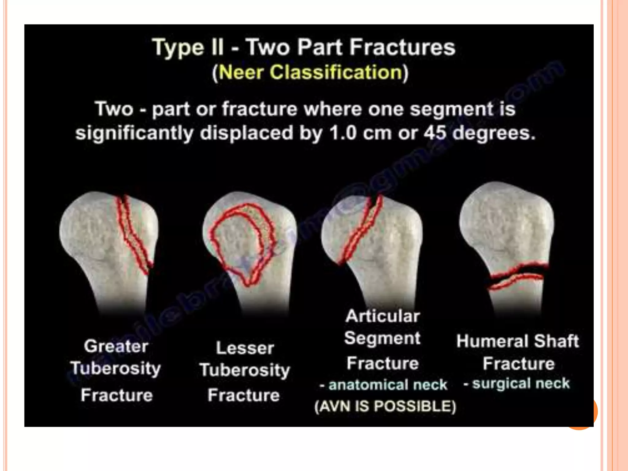 Proximal humerus fractures | PPTX