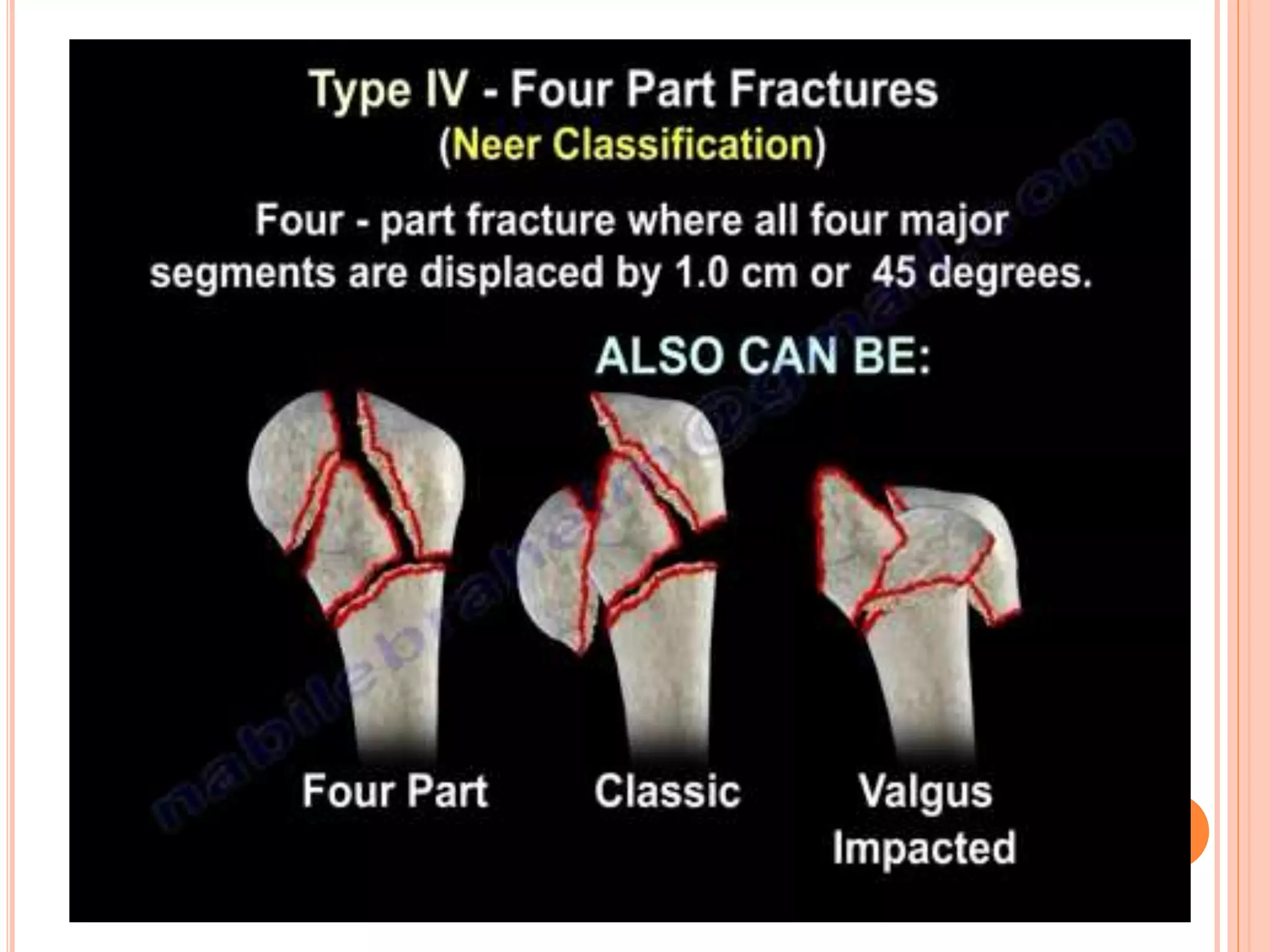 Proximal humerus fractures | PPTX