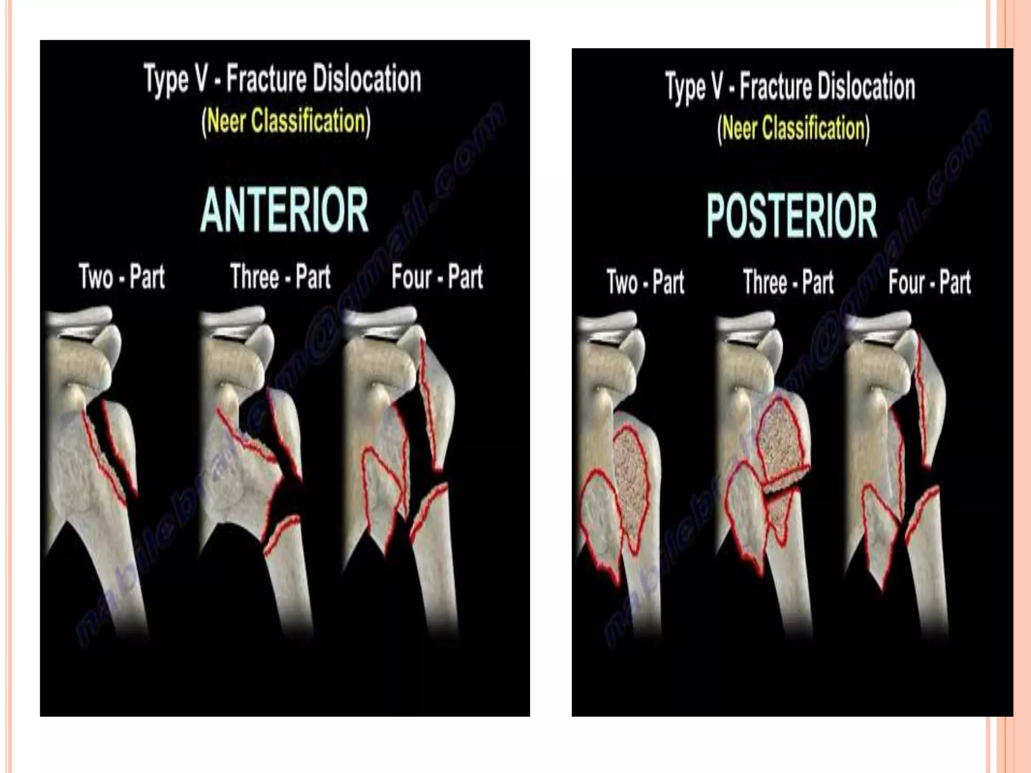 Proximal humerus fractures | PPTX