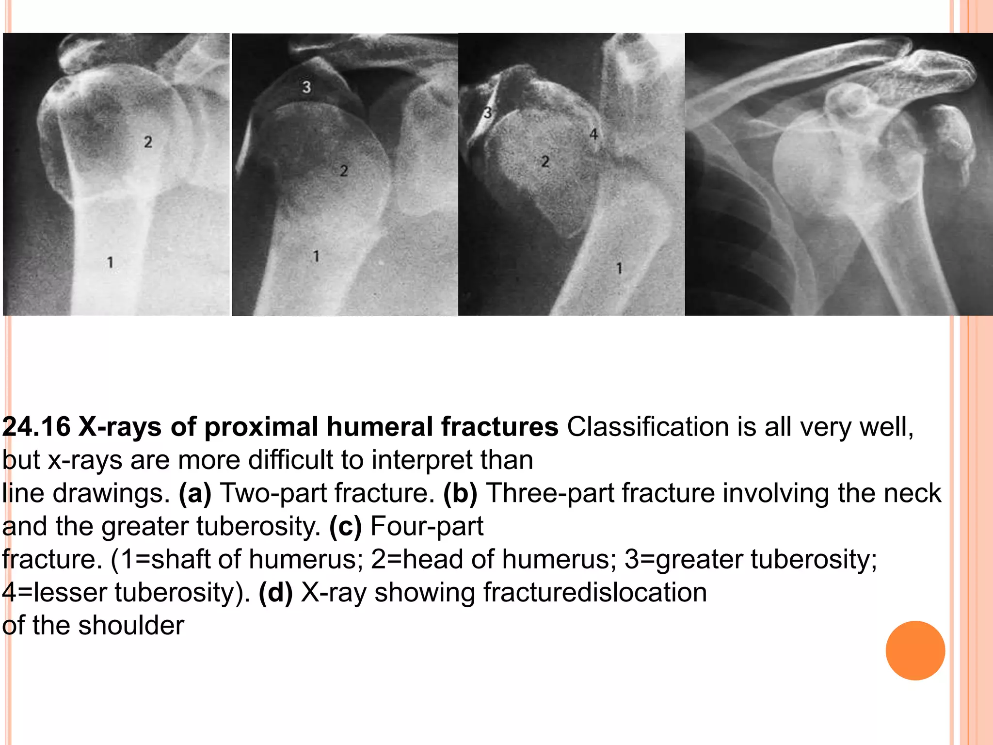 Proximal humerus fractures | PPTX